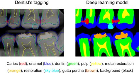Deep Learning For Proximal Caries Detection On Bitewing X Ray