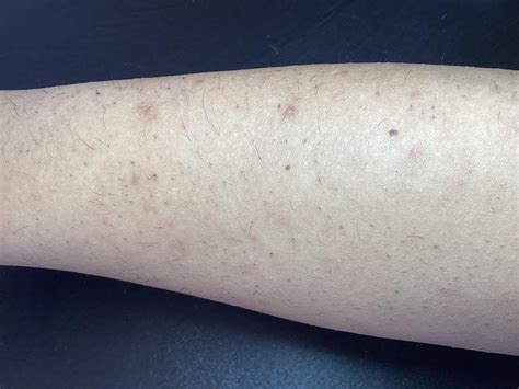 Ingrown Hairs After Waxing Hands Hair Removal Rskincareaddiction