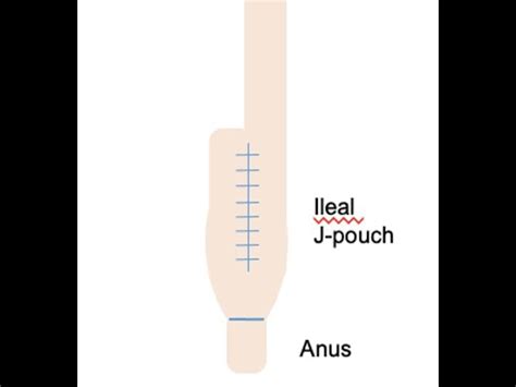 What Does A J Pouch Look Like Proctocolectomy Baylor Medicine