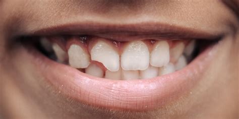 Root Canal Tooth Broke Off At Gum Line Northgate Vet