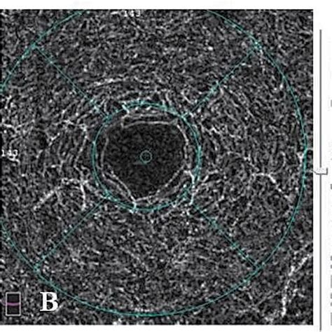 Layer Segmentation Of Retina And Fazs Parameters Using Octa A Vessel