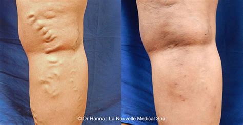 Before And After Photos Of Varicose And Spider Vein Removal By Dr