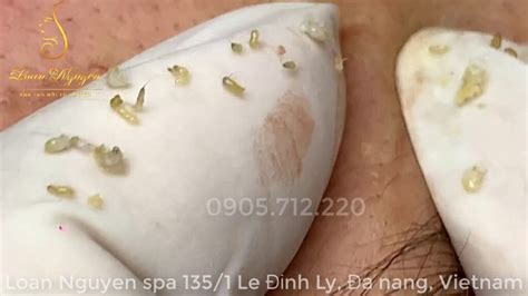 6 Year Old Cyst On Back Pop That Zit Since 2006