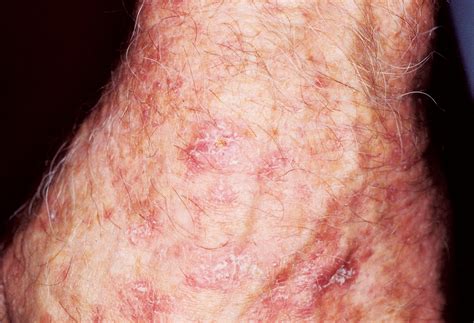 Actinic Keratosis Warning Signs And Images