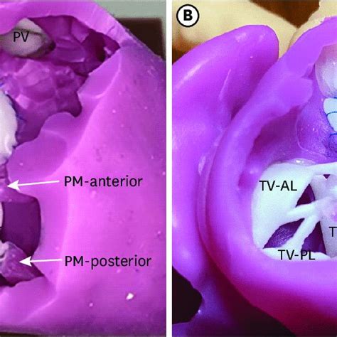 Silicone Molded Models For Vsd Closure The Anterior Wall Of The Right Download Scientific