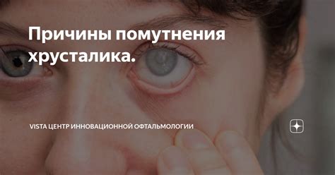 Причины помутнения хрусталика. | VISTA центр инновационной ...