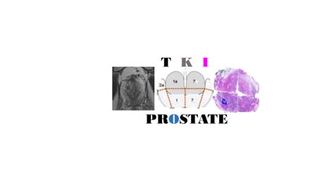 Personalized Prostate Cancer Management Using Multi Parametric Mri And Machine Learning