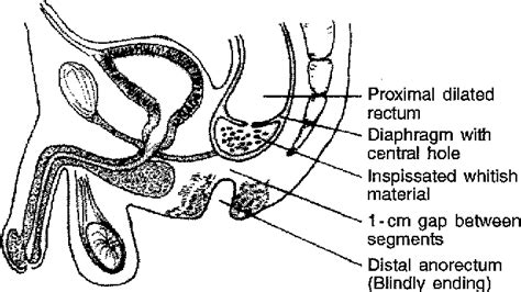 Combined Rectal Atresia And Rectal Stenosis Semantic Scholar
