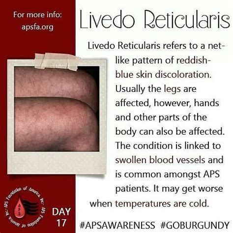 Livedo Reticularis Hands