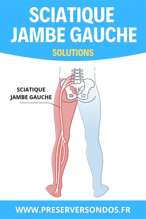 Sciatique Jambe Gauche Causes Solutions Exercices Sciatique Sciatique Jambe Douleur