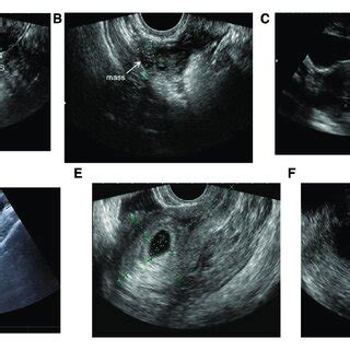 Ultrasound Images Showing Several Types Of Ovarian Pregnancy A