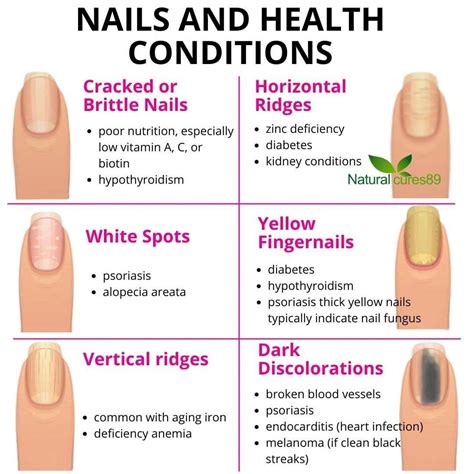 Nail Diseases Chart Pictures Symptoms And Treatments Artofit