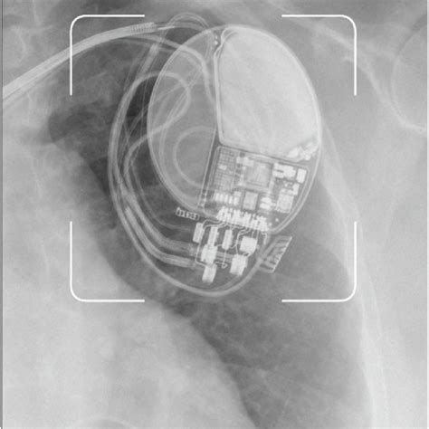 Pacemaker Id Application User Interface Download Scientific Diagram