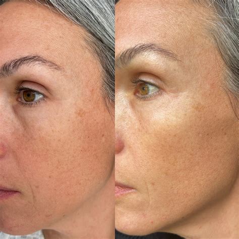 A Beginners Guide To Natural Retinol With Before And After Pics The