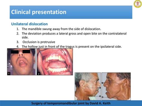 Temporomandibular Joint Dislocation Pptx