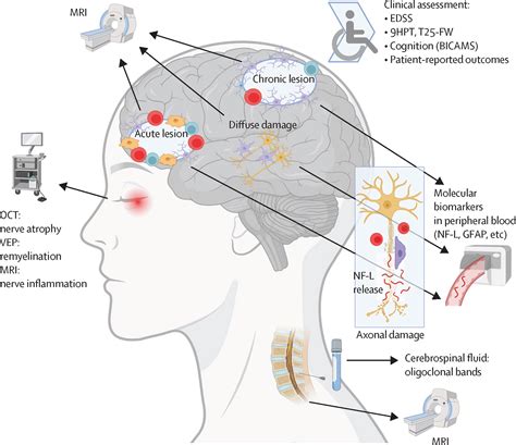 Multiple Sclerosis The Lancet