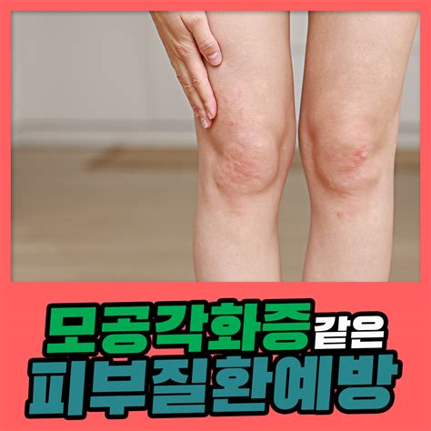 모공각화증 및 어린선과 같은 피부 질환 예방법 건강검진정보