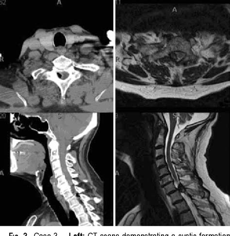 Figure 1 From Extend Synovial Cysts Of The Cervicothoracic Junction
