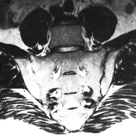 T2 Weighted Magnetic Resonance Imaging Shows An Increased Signal Download Scientific Diagram