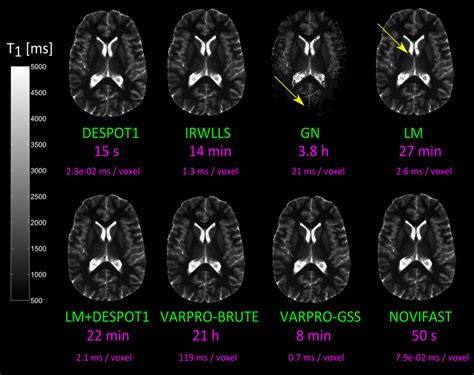Mid Axial Slice Of The Estimated 3d T 1 Map With The Vfa T 1 Estimation Download Scientific