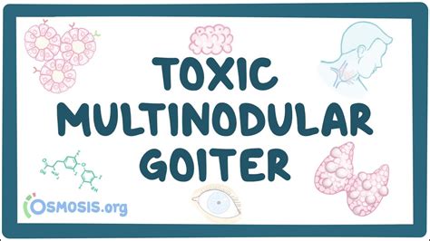 Toxic Multinodular Goiter Video Causes Meaning Osmosis