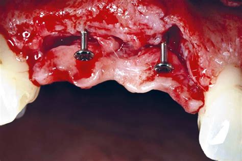 Vertical Ridge Augmentation With Permamem® Cerabone® And Autologous Bone Chips Botiss