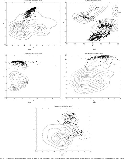Figure 5 From Ecg Analysis Using Nonlinear Pca Neural Networks For Ischemia Detection Semantic