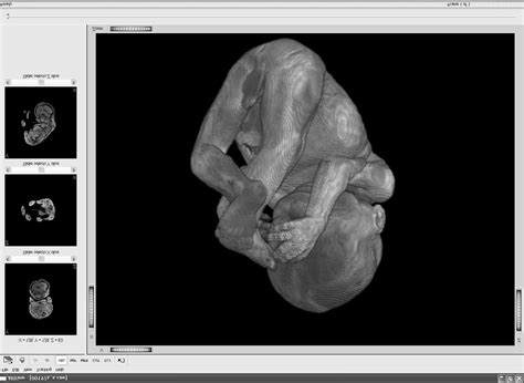 3dview volume rendering interface and segmented fetus model from mr