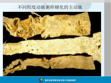 动脉粥样硬化病理图谱 Word文档在线阅读与下载 无忧文档