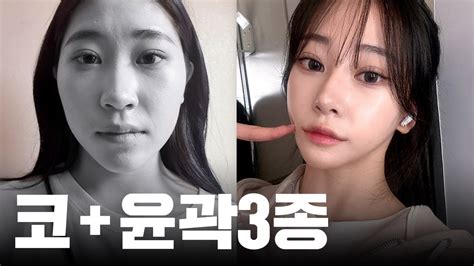 윤곽코 수술로 얼굴 체인지 │리얼스토리│성형브이로그 Youtube