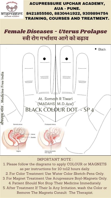 Female Diseases Uterus Prolapse स्त्री रोग गर्भाशय Acupressure Colour Theropy By Somesh Tiwari