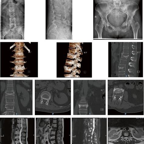 The Imageological Examinations Showed Fresh Second Vertebra Fracture Download Scientific