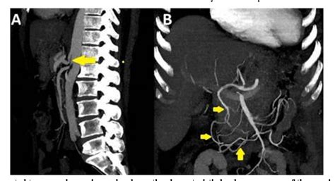 Figure 1 From Synchronous Celiac Artery And Superior Mesenteric Artery