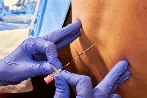Epidural Steroid Injection In New York Epidural Steroid Injection