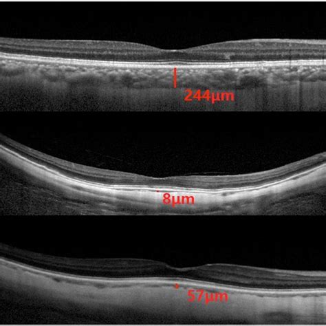 Cross Sectional Imaging Of The Choroid Using Enhanced Depth Imaging