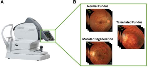 Frontiers Fundus Image Classification Using Inception V3 And Resnet 50 For The Early