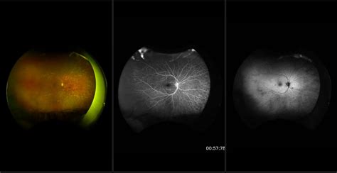California Branch Retinal Artery Occlusion Rg Af Fa