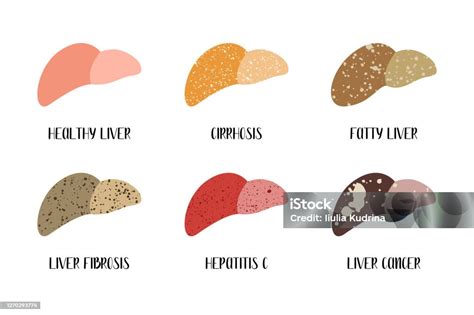 건강한 간 및 다양한 간 질환 간학 간 손상의 단계 간경변 지방 섬유증 C형 간염 암 벡터 플랫 일러스트레이션 전단지 의료 브로셔 배너에 적합 간 내부 기관에 대한 스톡