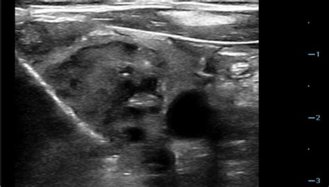 The How To Of Thyroid Rfa Technique And Post Procedure Management