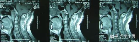 小脑扁桃体下疝脊髓空洞枕下减压术后假性脑膜膨出脑积水手术治疗失败并发症，昏迷生命垂危，被李小勇脑脊液科治完好10年后仍很健康 知乎