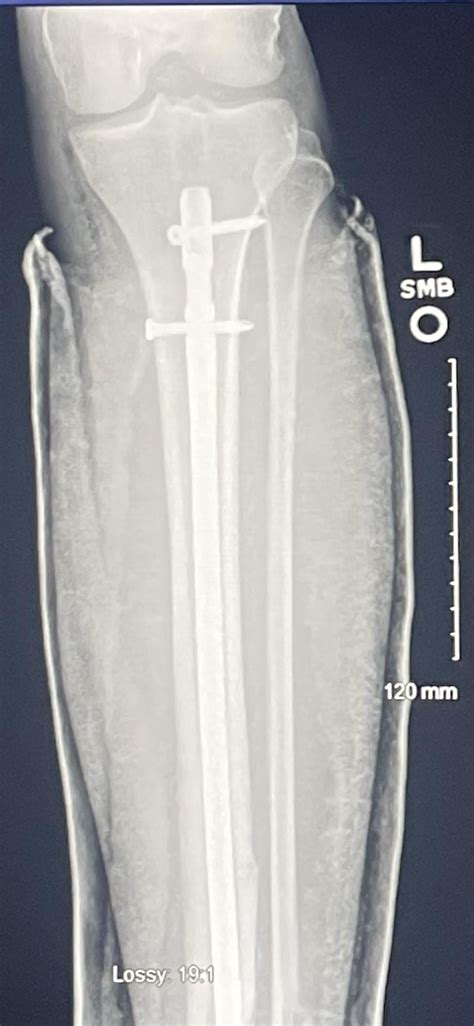 Broken Tibia 5 Times Fibula 1 R Brokenbones