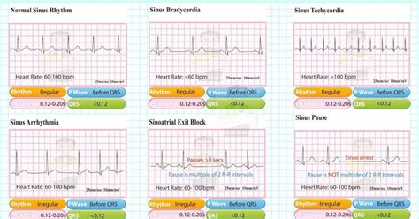 The Sinus Node Sa Is Located In The Roof Of The Right Atrium It Is The Fastest Physiological