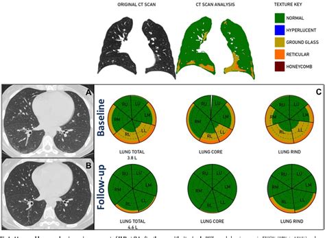 Lung Parenchyma And Interstitium
