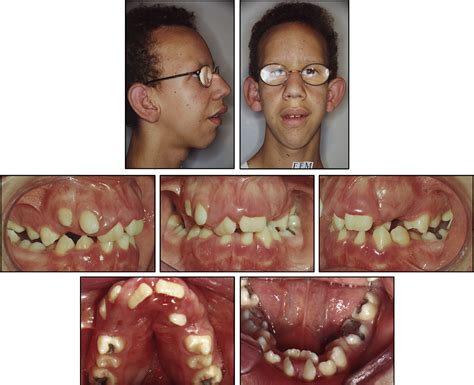 Figure 1 From Orthodontic Treatment Of A Patient With Lowe Syndrome