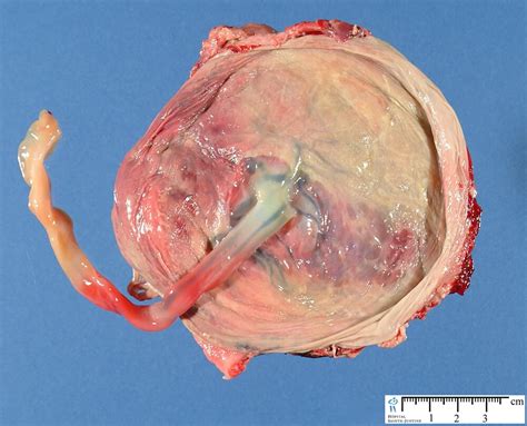 Acute Chorioamnionitis Human Pathology Photos