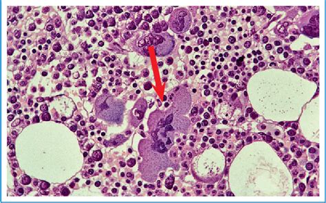 Pdf Maladie De Vaquez Semantic Scholar