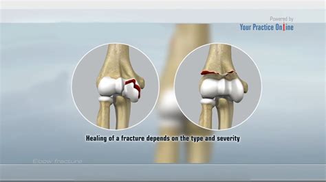 Elbow Fracture Video Medical Video Library