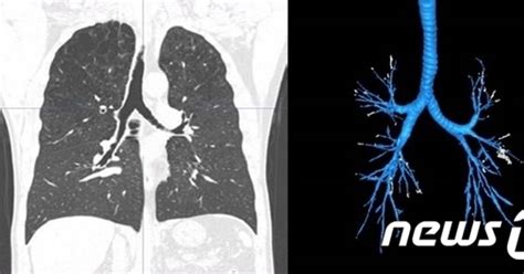 만성폐쇄성폐질환 찾아내는 토종 Ai소프트웨어 임상 돌입