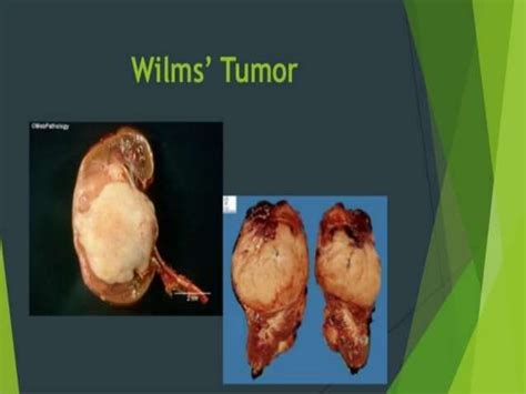 Wilms Tumor Ppt