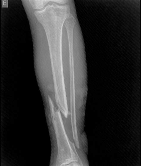 Tíbia O Principal Osso Da Perna Dr Thiago Protta